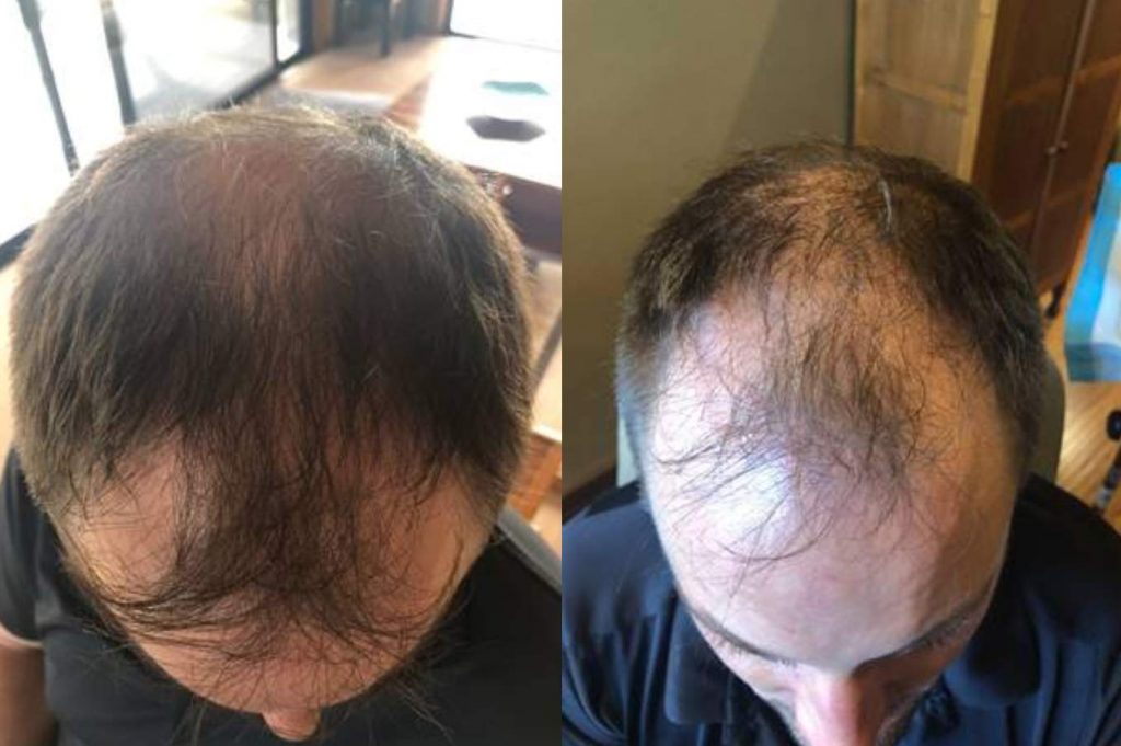 before-after-prp_opt | Hawaii's Innovator in Platelet Rich Plasma (PRP ...